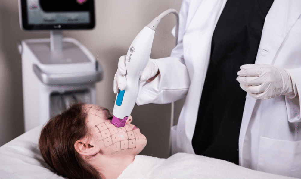Thermage Skin Tightening in Delhi & Indore | Monaris Skin & Hair Clinic